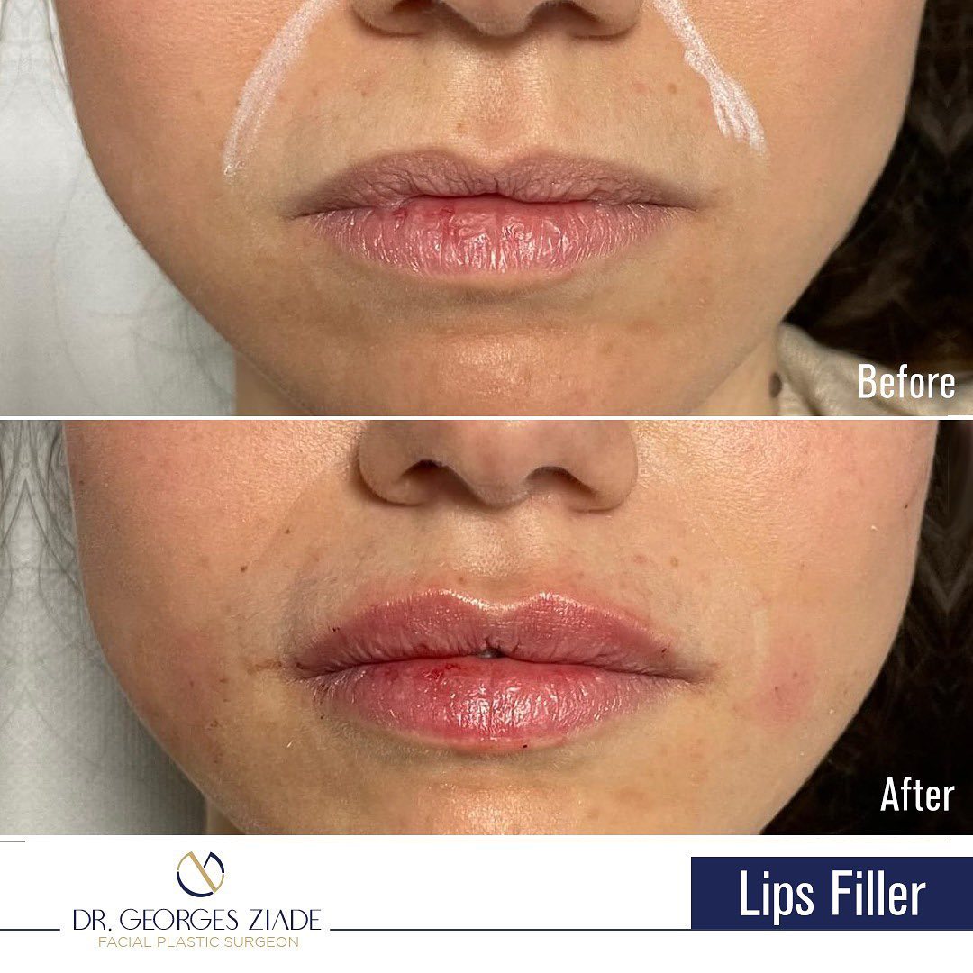 Fillers – Dr. Georges Ziade Clinics
