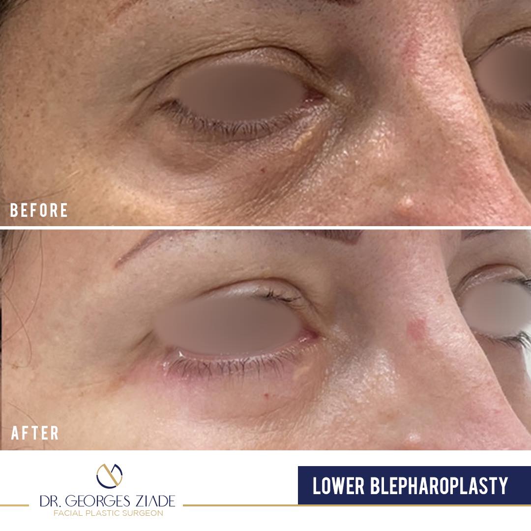Lower Blepharoplasty – Dr. Georges Ziade Clinics