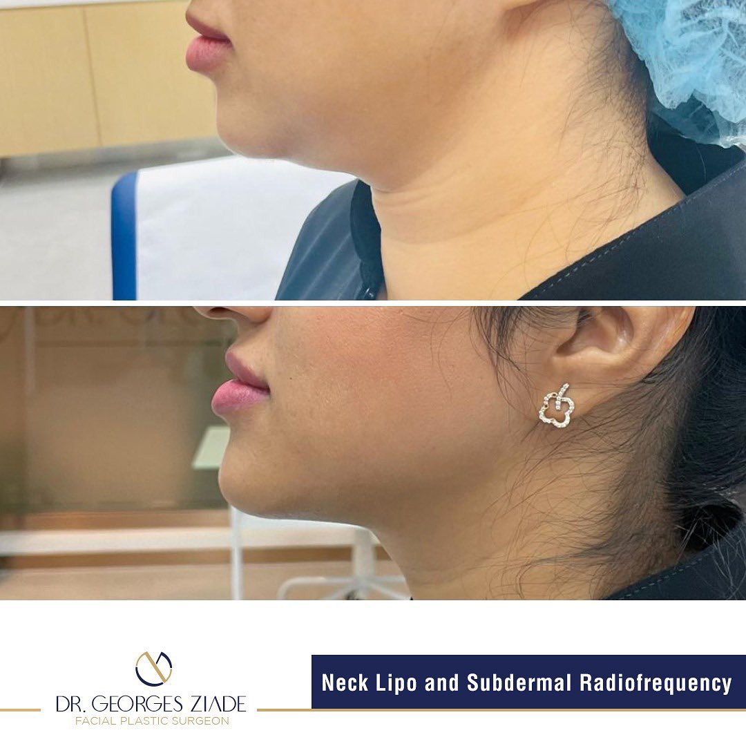 Neck Liposuction – Dr. Georges Ziade Clinics