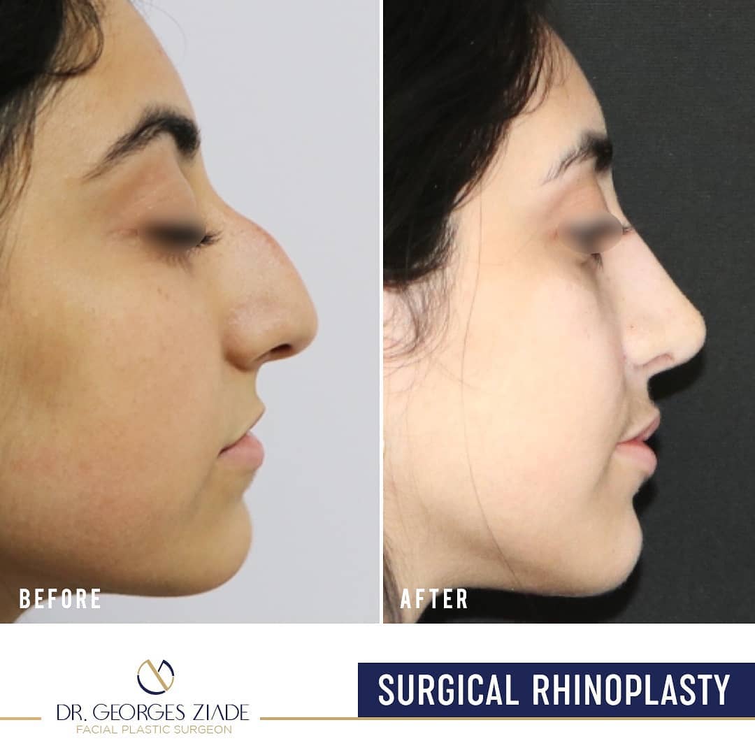 Rhinoplasty – Dr. Georges Ziade Clinics